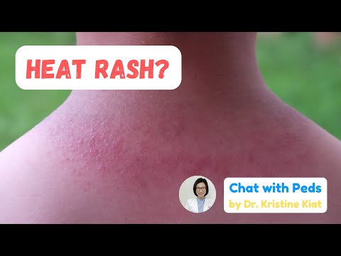 Heat Rash (Bungang Araw) in Babies and Children | Chat with Peds | Dr. Kristine Alba Kiat