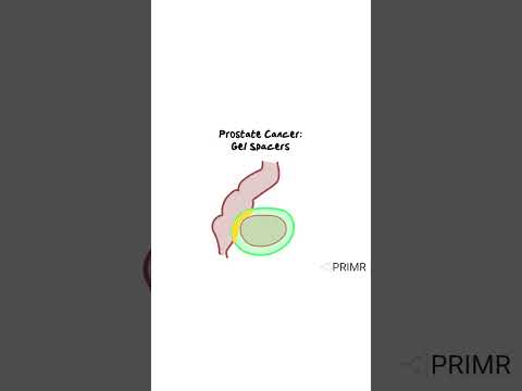 "I have #prostatecancer—how can a gel spacer help protect my rectum during radiation?”