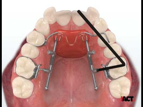 Molar Distalization Procedure with Bowman Modification from AOA Laboratories