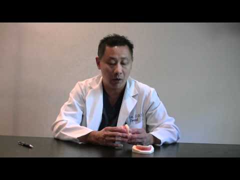 Complete Dentures-Advantages and Disadvantages, Toronto Dental Office