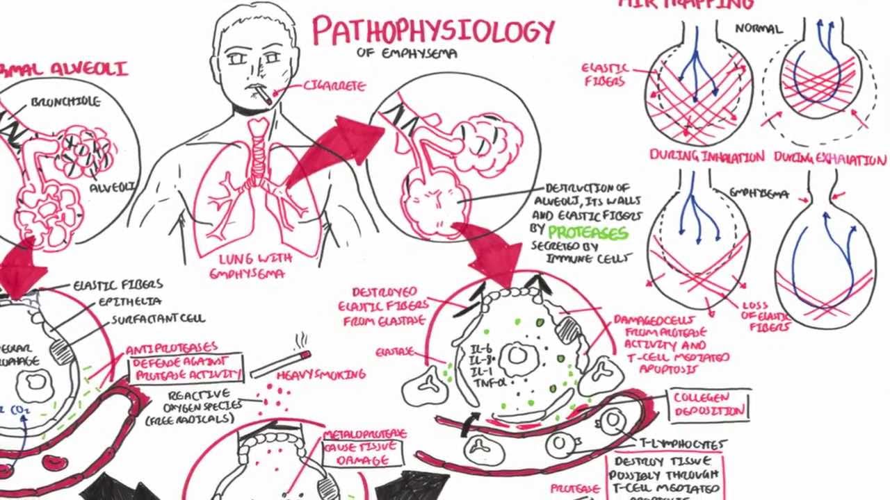 Emphysema - Pathophysiology (COPD)
