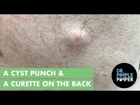 Dr. Pimple Popper Scrapes Away Back Cyst With Curette In Youtube Video