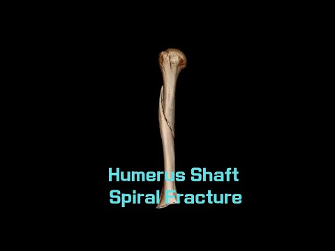 Humerus shaft spiral fracture 상완골 나선형 골절
