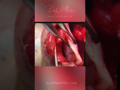 A Very Extreme Case of Deviated Septum