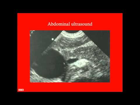 Pancreatic Pseudocyst - CRASH! Medical Review Series