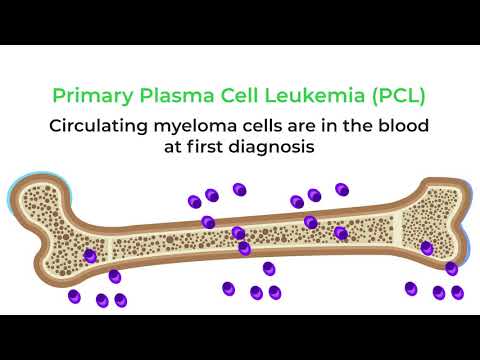 Myeloma Basics Part 1 (2019): Primary PCL vs. Secondary PCL | HealthTree University Multiple Myeloma