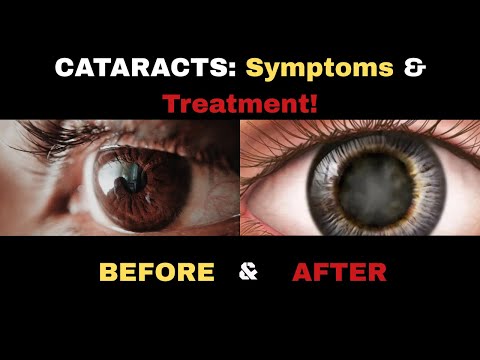 Understanding Cataracts Causes, Symptoms & Treatment