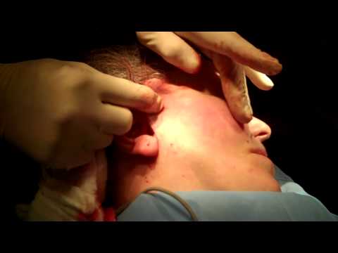 Singer MiniFacelift : Advances in Technique. www.singerminfacelift.com