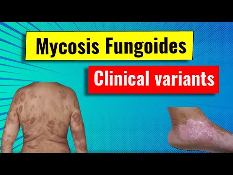 Clinical variants of Mycosis fungoides (MF)