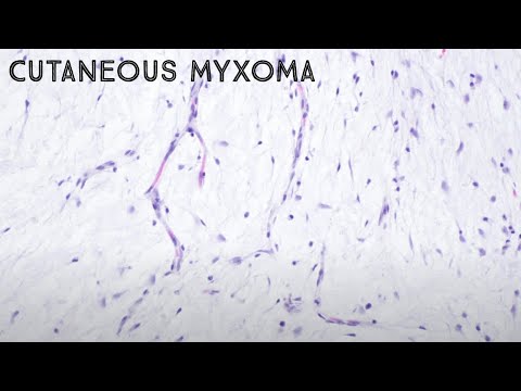 Cutaneous Myxoma (superficial angiomyxoma) (pathology dermpath dermatology dermatopathology)