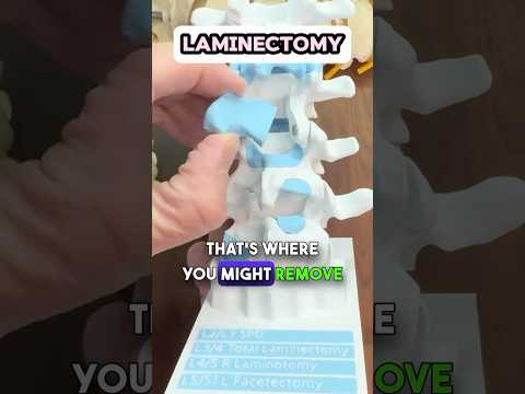 Real Laminectomy Example (DemoSpine)