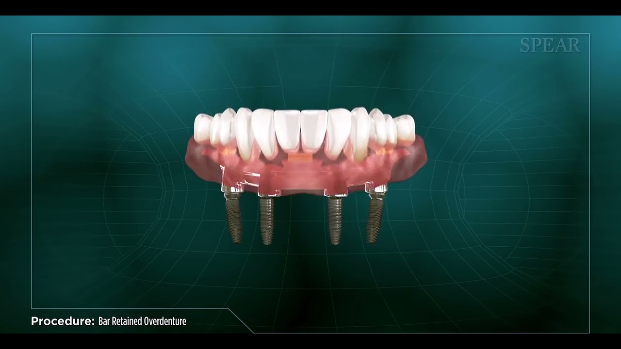 Bar Retained Overdenture