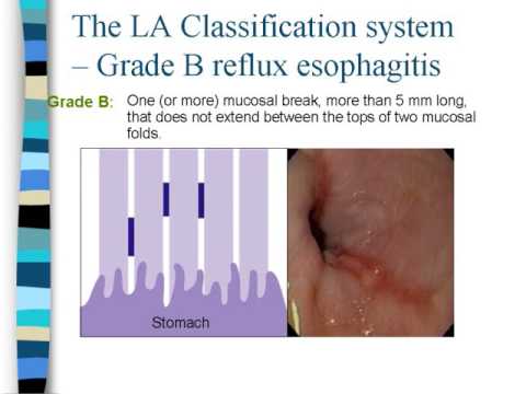 The LA Classification system 2
