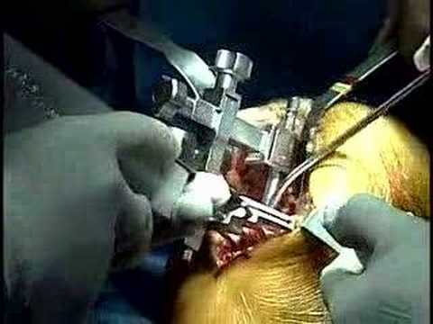 Podcast: Minimally Invasive Total Knee Replacement
