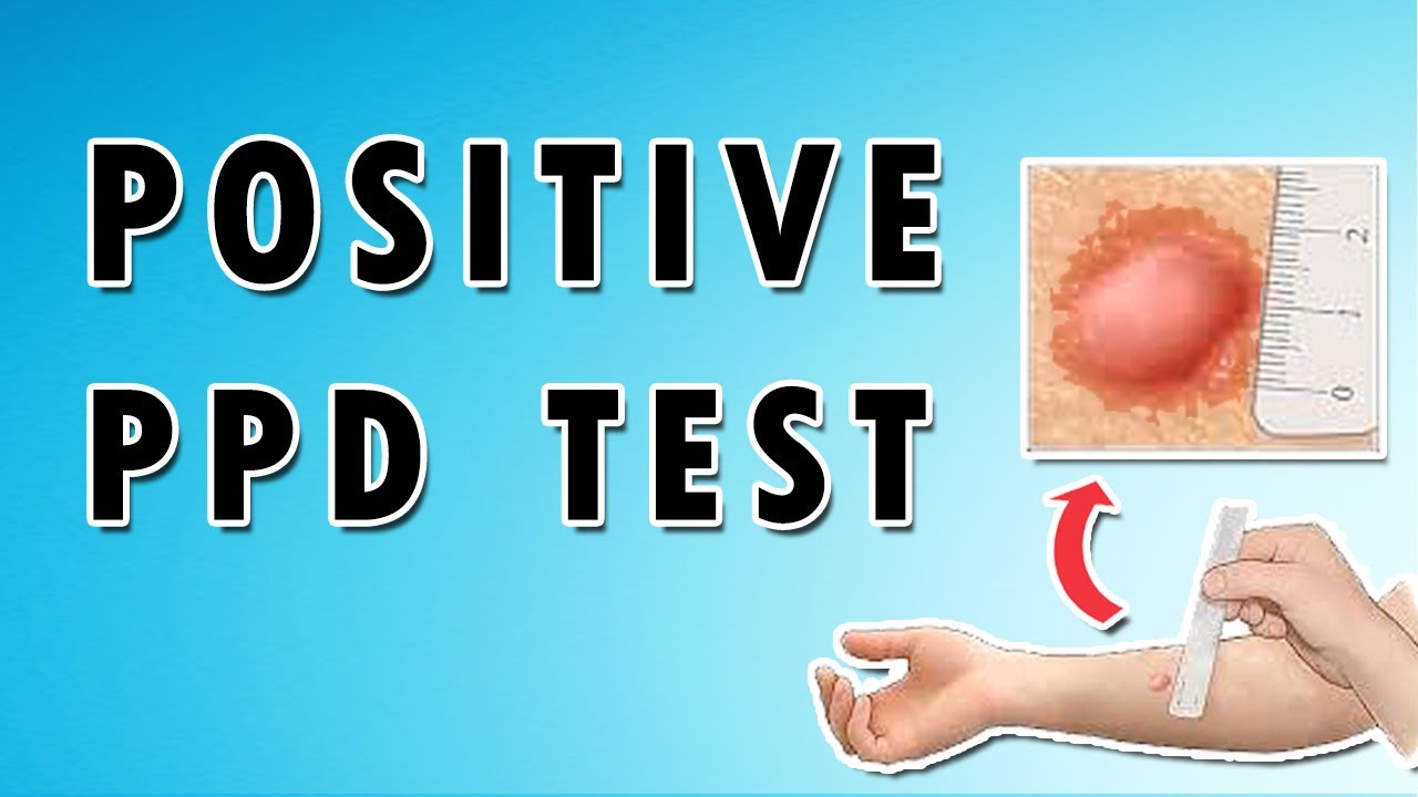 Positive PPD Test