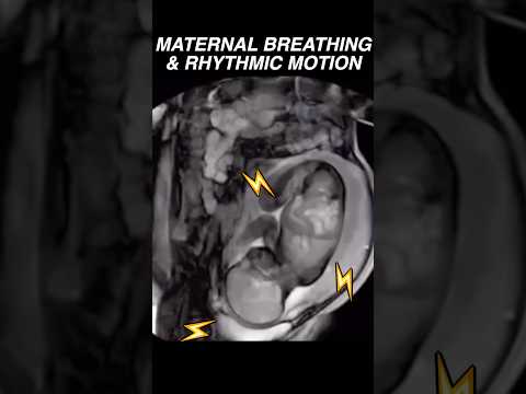 Maternal breathing provides rhythmic motion for baby visualized via MRI #radiology #pregnancy #mom