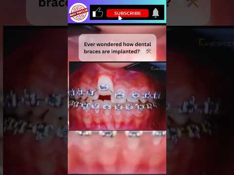 Using braces to pull out impacted teeth 😱🦷 #shorts #viral #trending