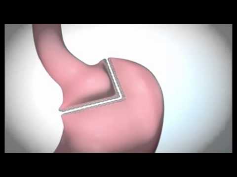 Gastric Bypass - Roux en Y Educational Video
