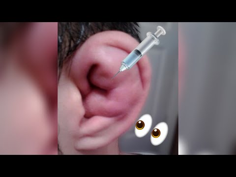 How to treat Cauliflower ear (Aural Hematoma) for under $5 in under 2 minutes