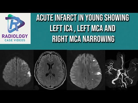 Acute infarct in young showing Left ICA , Left MCA and Right MCA Narrowing