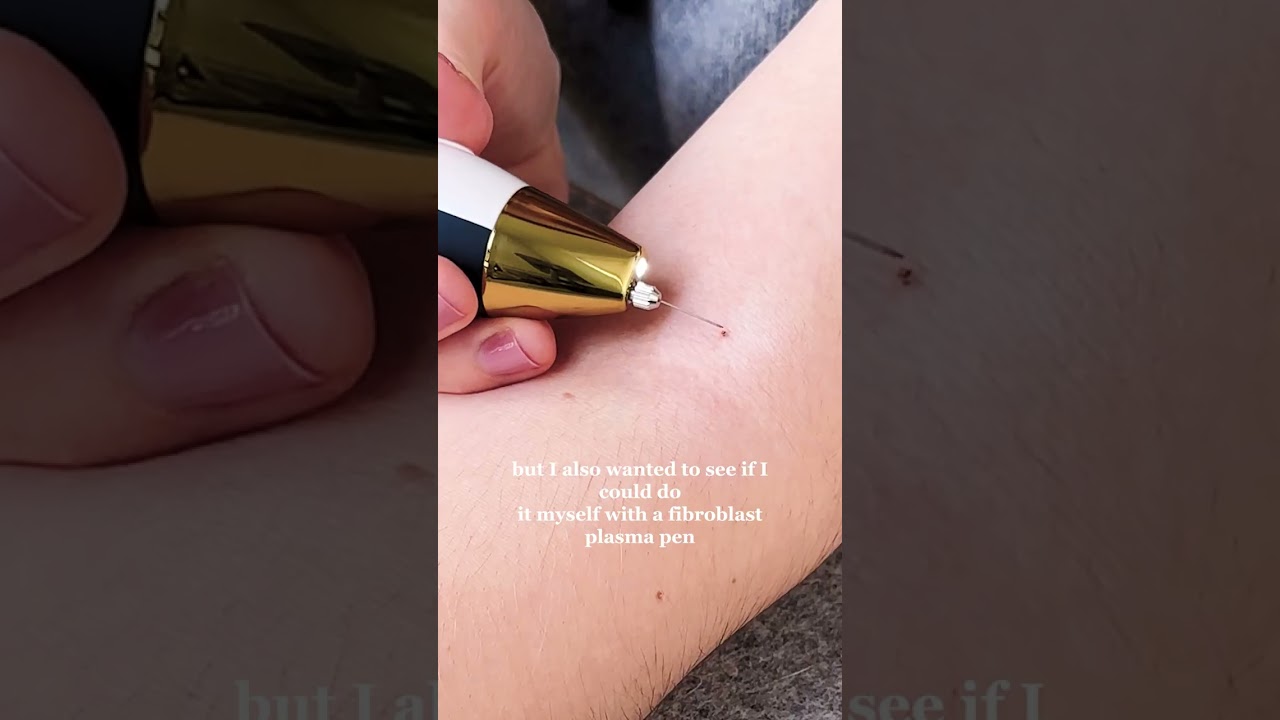 MY EXPERIENCE REMOVING SKIN TAGS AT HOME VS CLINIC #shorts