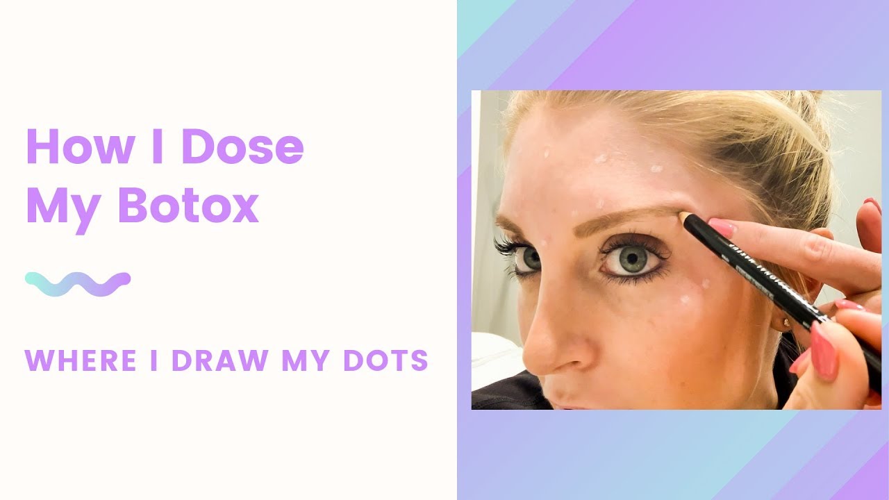 How I Dose my Botox | Where I Draw My Dots