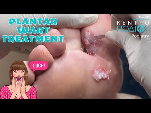 Plantar Wart Treatment #feet #kentropodiou #κεντροποδιου #podologos #podiatrist #podiatry #podologia