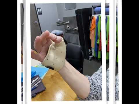Custom Static and Dynamic Splinting