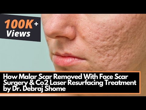 How Malar Scar Removed With Face Scar Surgery & Co2 Laser Resurfacing Treatment