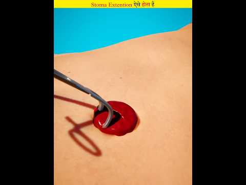 This is how doctor places colostomy bag on stoma