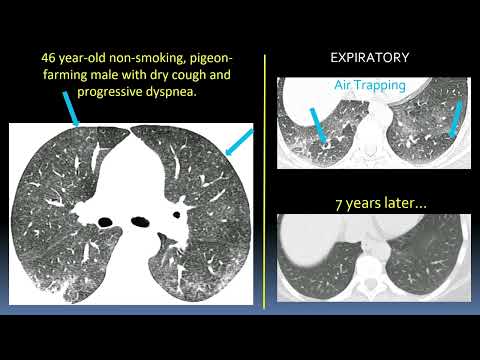 High-Resolution Chest CT - Course Sample