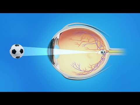 Nearsightedness (Myopia)