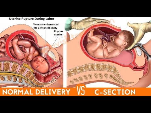 Medical Animation: Cesarean Delivery