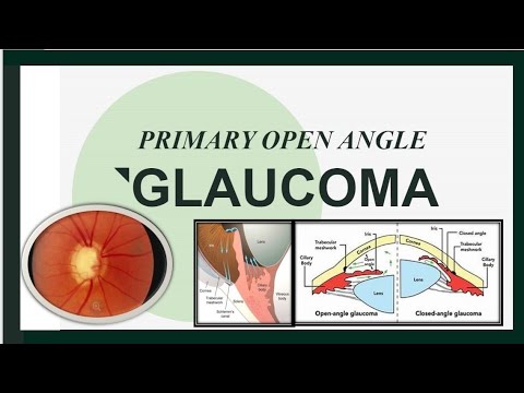 Primary Open Angle Glaucoma (POAG)