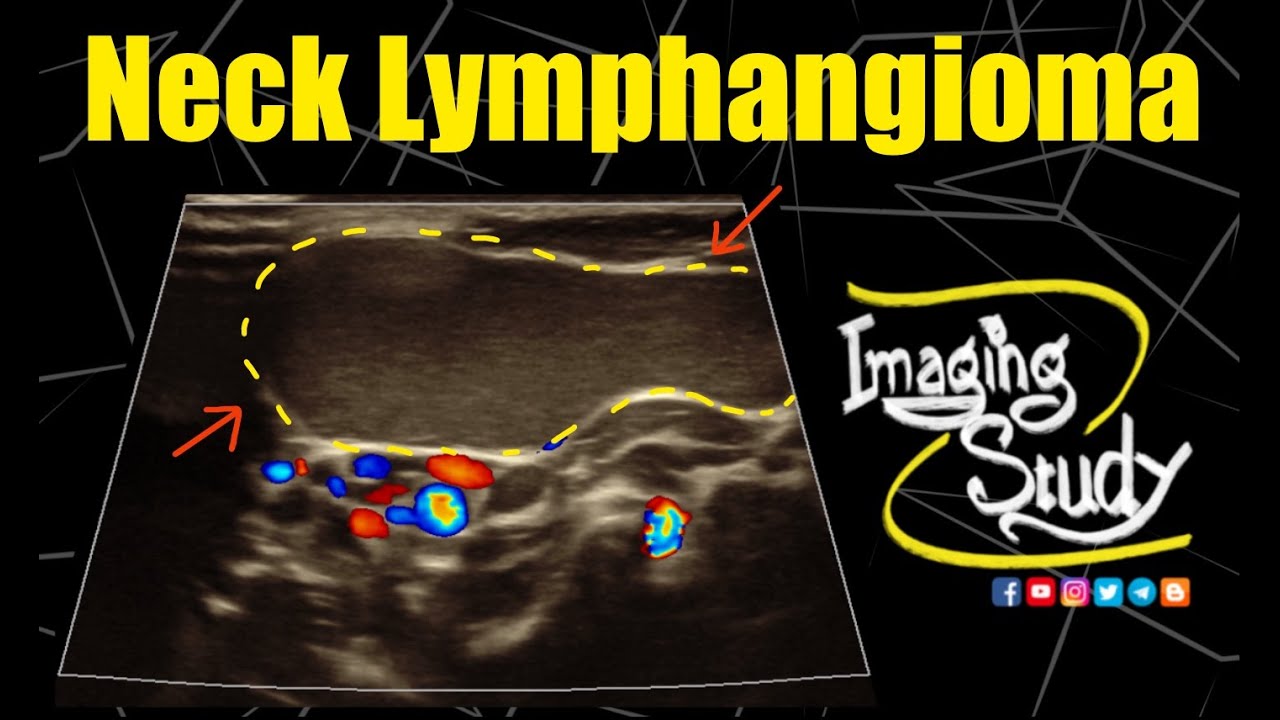 Understanding Neck Lymphangioma: A Case Study | Galaxy.ai