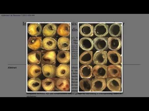 What Starts Alzheimer's, What Stops It