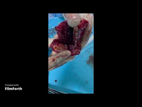 Commando operation (bite composite resection) surgery for mouth cancer #headandneckcancer #omfs