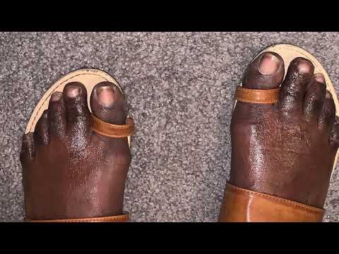 BEFORE & AFTER: THE ULTIMATE COSMETIC PROCEDURE (TOE SHORTENING, HAMMERTOE CORRECTION AND MORE) β€οΈ