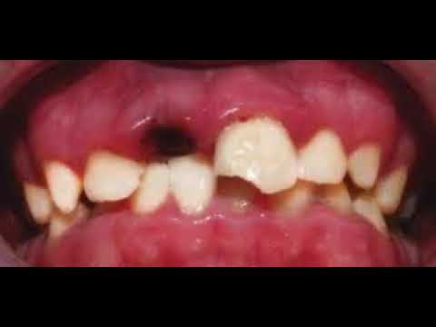 Podcast 810: Tooth Replantation