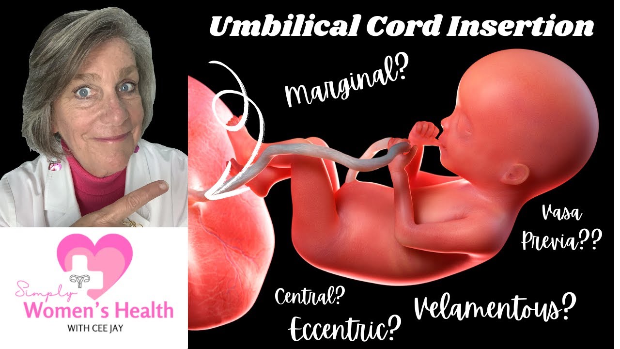 Umbilical Cord Insertion: Why Does It Matter??