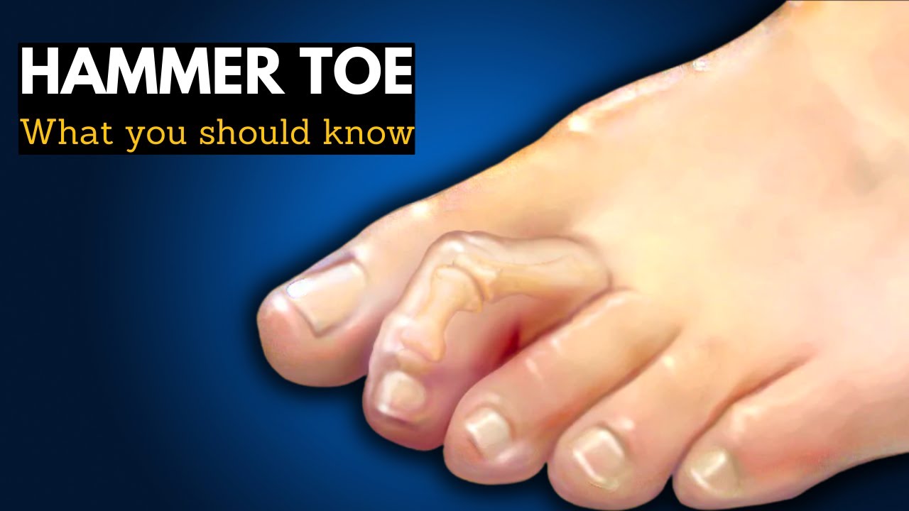 Hammer Toe or Mallet Toe, Causes, Signs and Symptoms, Diagnosis and Treatment.