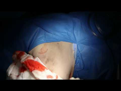 thigh intermuscular lipoma in a dog