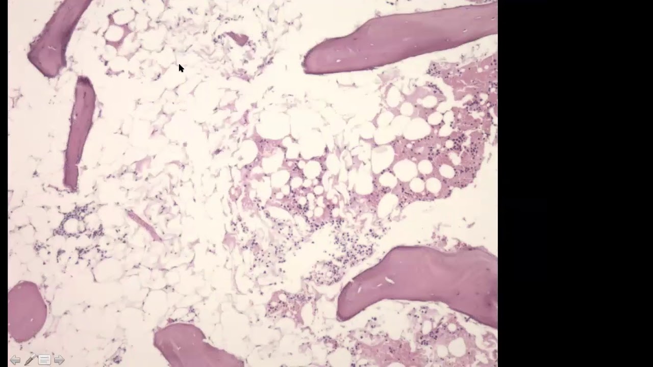 Dr. Naglaa Salem, MD, FCAP- Interpretation of BM Biopsies