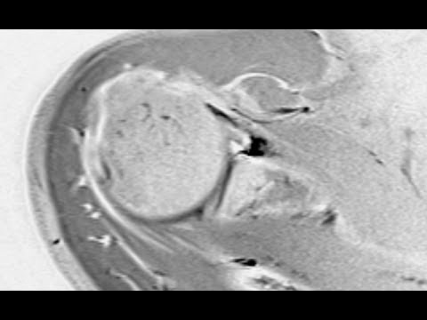 Anterior Inferior Labrum Tear of the Shoulder
