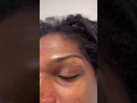Brow bone reduction before and after | Dr. Sarah Saxon