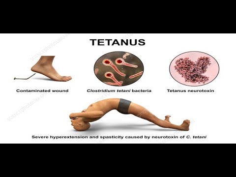 L7: Immunology: Antiserum; Treatment of Tetanus and Rabies