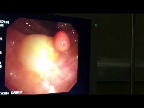 Dr Prakash Dangi,Gastroenterologist. Juvenile polyp - Polypectomy (15 yrs old boy)