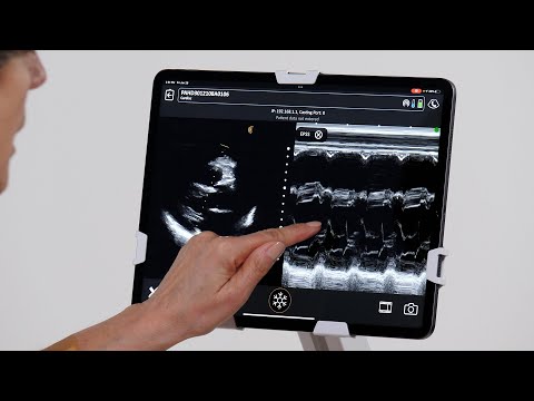 Ejection Fraction with EPSS