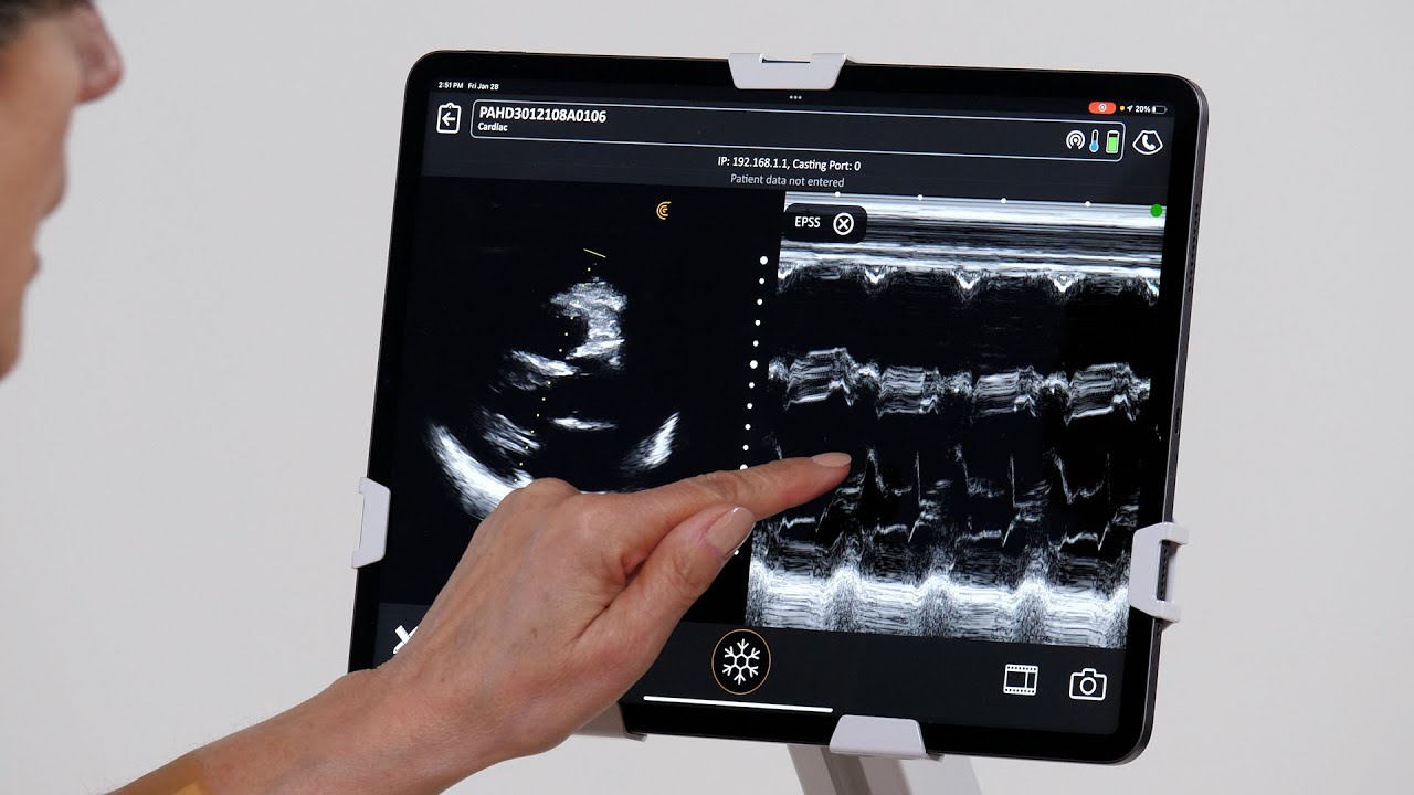 Ejection Fraction with EPSS