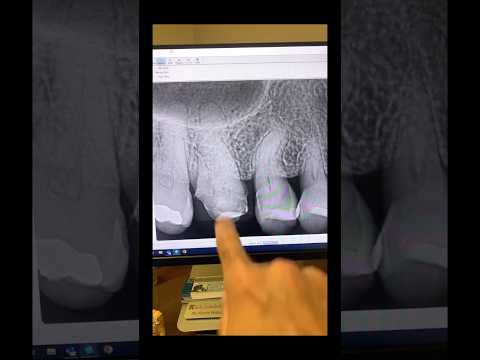 This calcified tooth #3 was a challenge! #endodontist #rootcanal #dentist #dentistry #dentalclinic